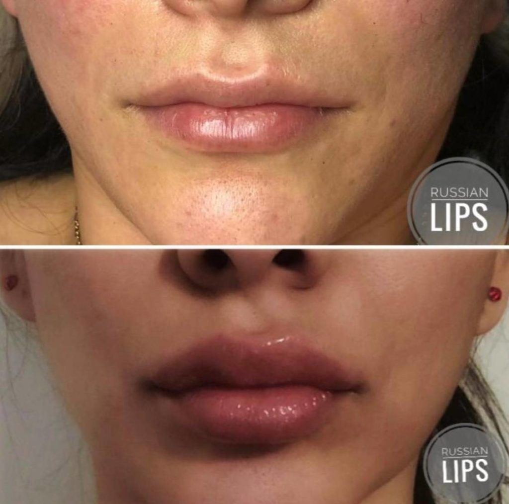 Lip Enhancement - All Beauty Laser
